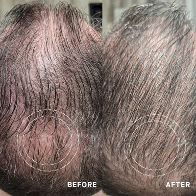 OS-01 HAIR SCALP SERUM – OneSkin